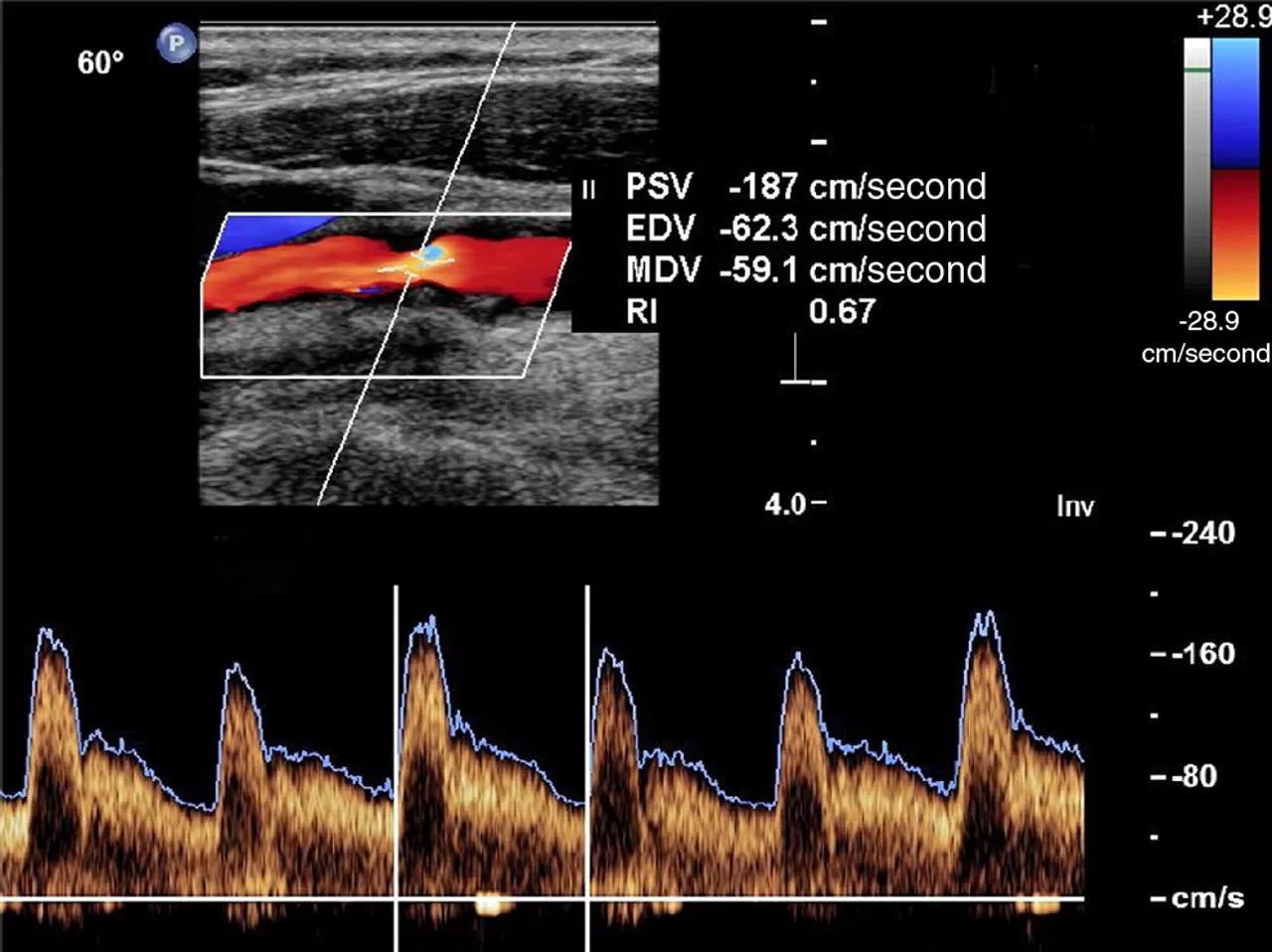Ecodoppler TSA - Istituto Galeno